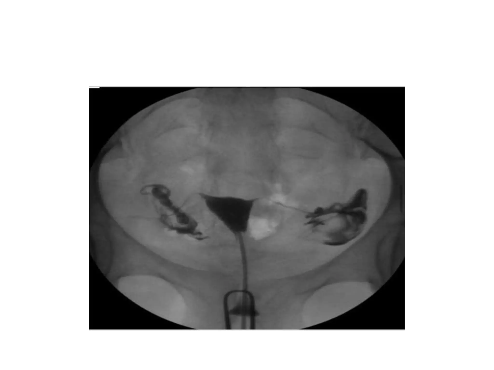 HSG AND FISTULOGRAM.pptx
