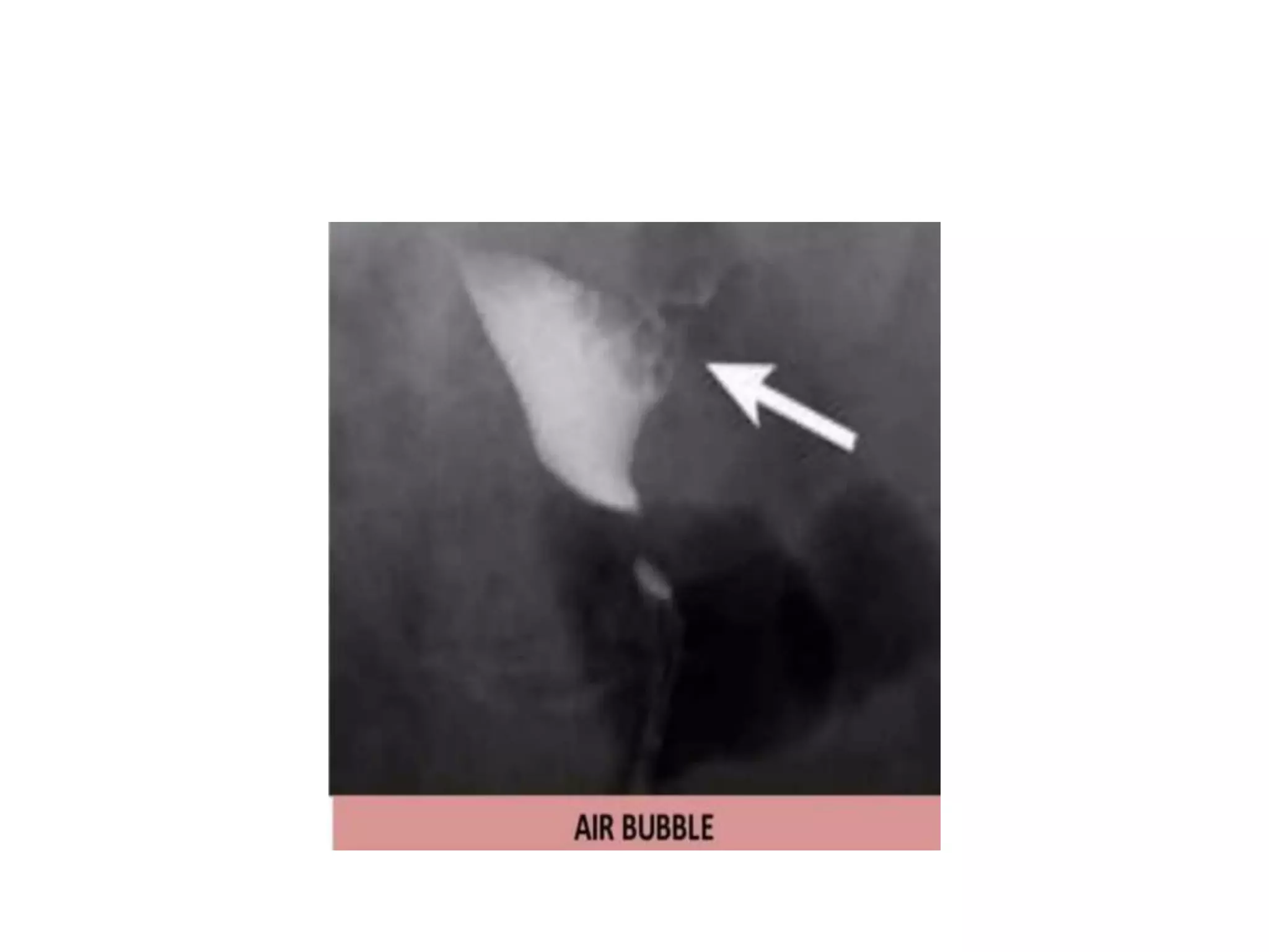 HSG AND FISTULOGRAM.pptx