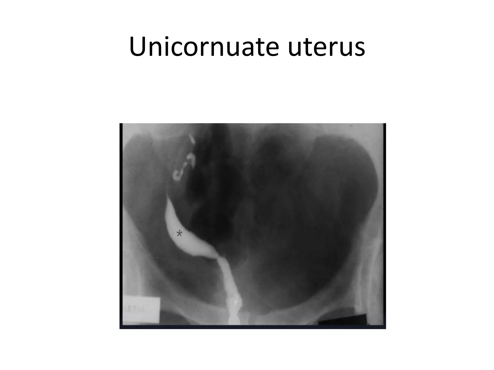 HSG AND FISTULOGRAM.pptx