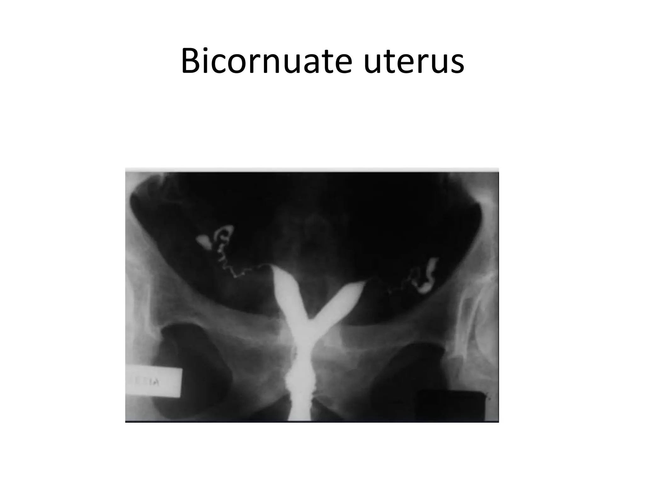 HSG AND FISTULOGRAM.pptx