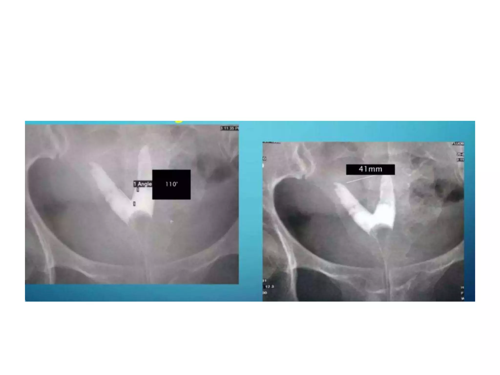 HSG AND FISTULOGRAM.pptx