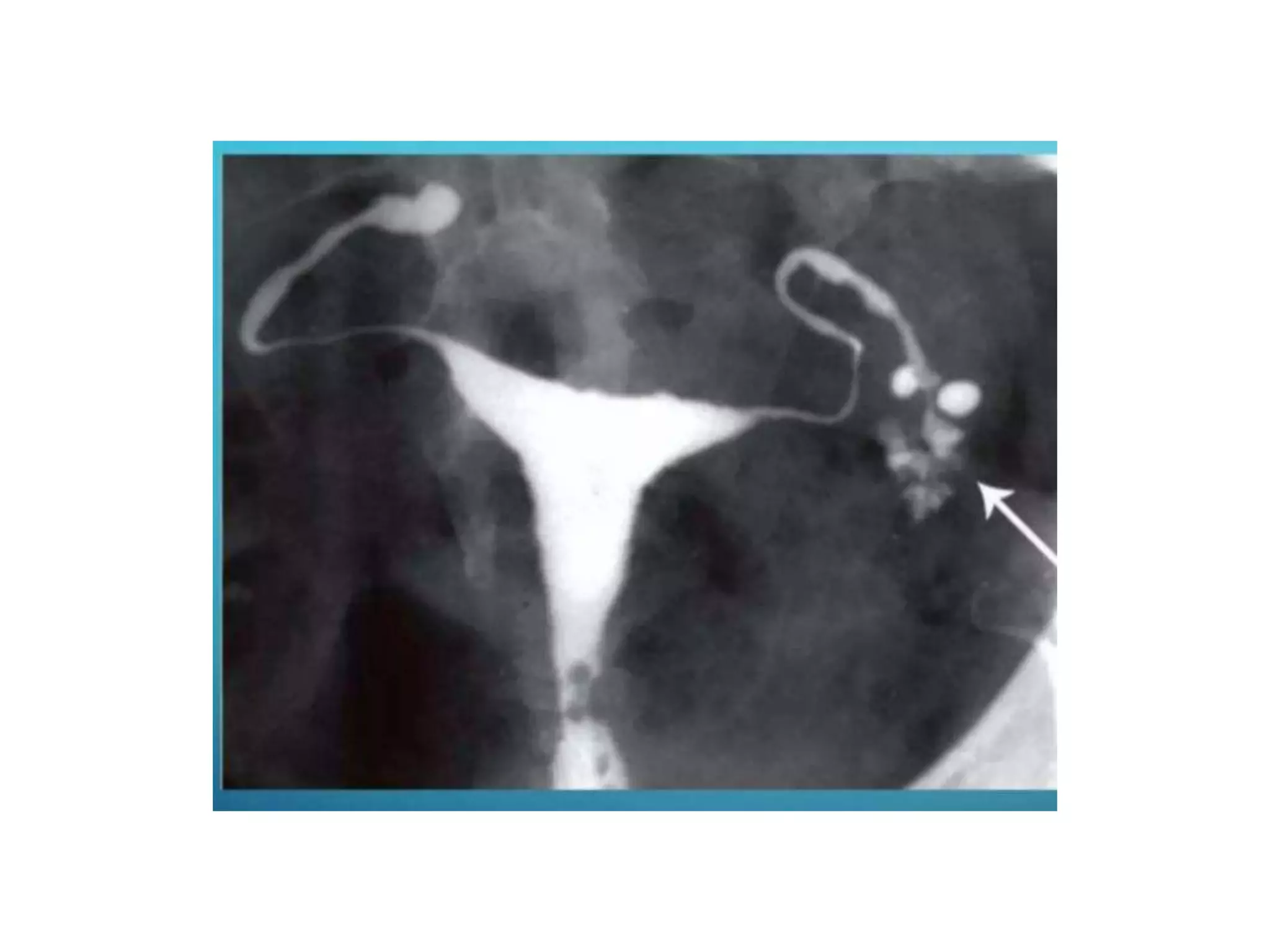 HSG AND FISTULOGRAM.pptx