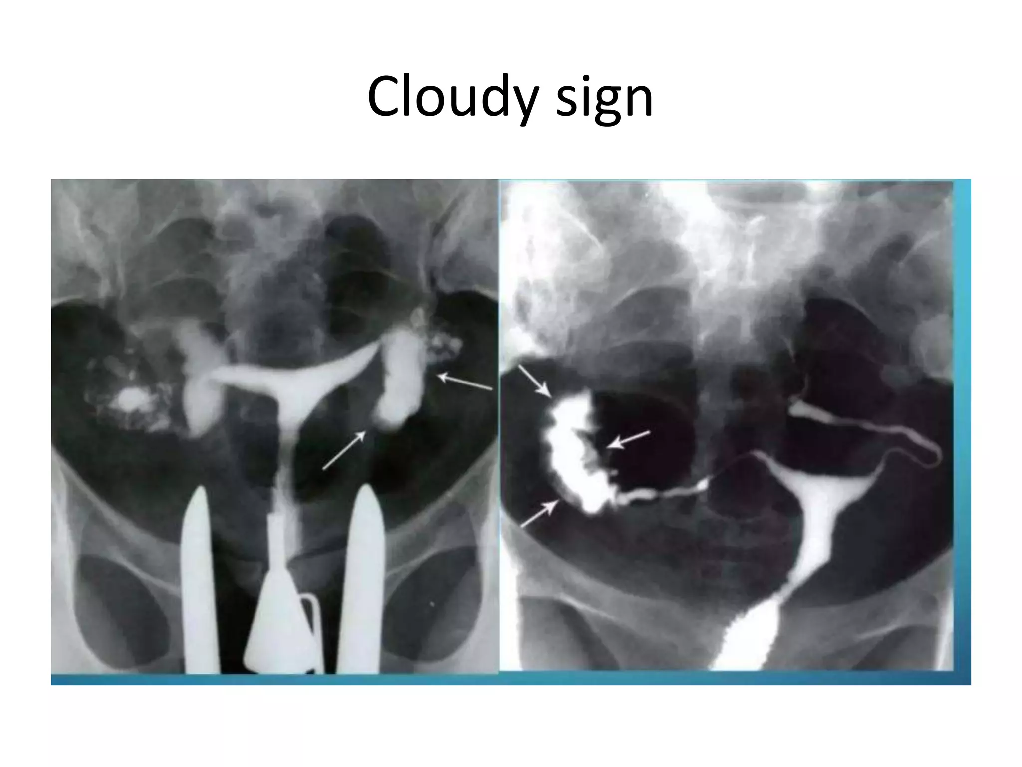 HSG AND FISTULOGRAM.pptx
