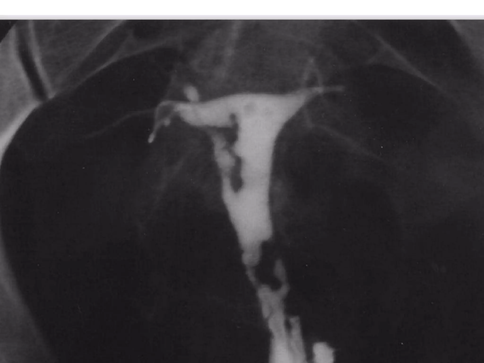 HSG AND FISTULOGRAM.pptx | Pregnancy | Reproductive Health