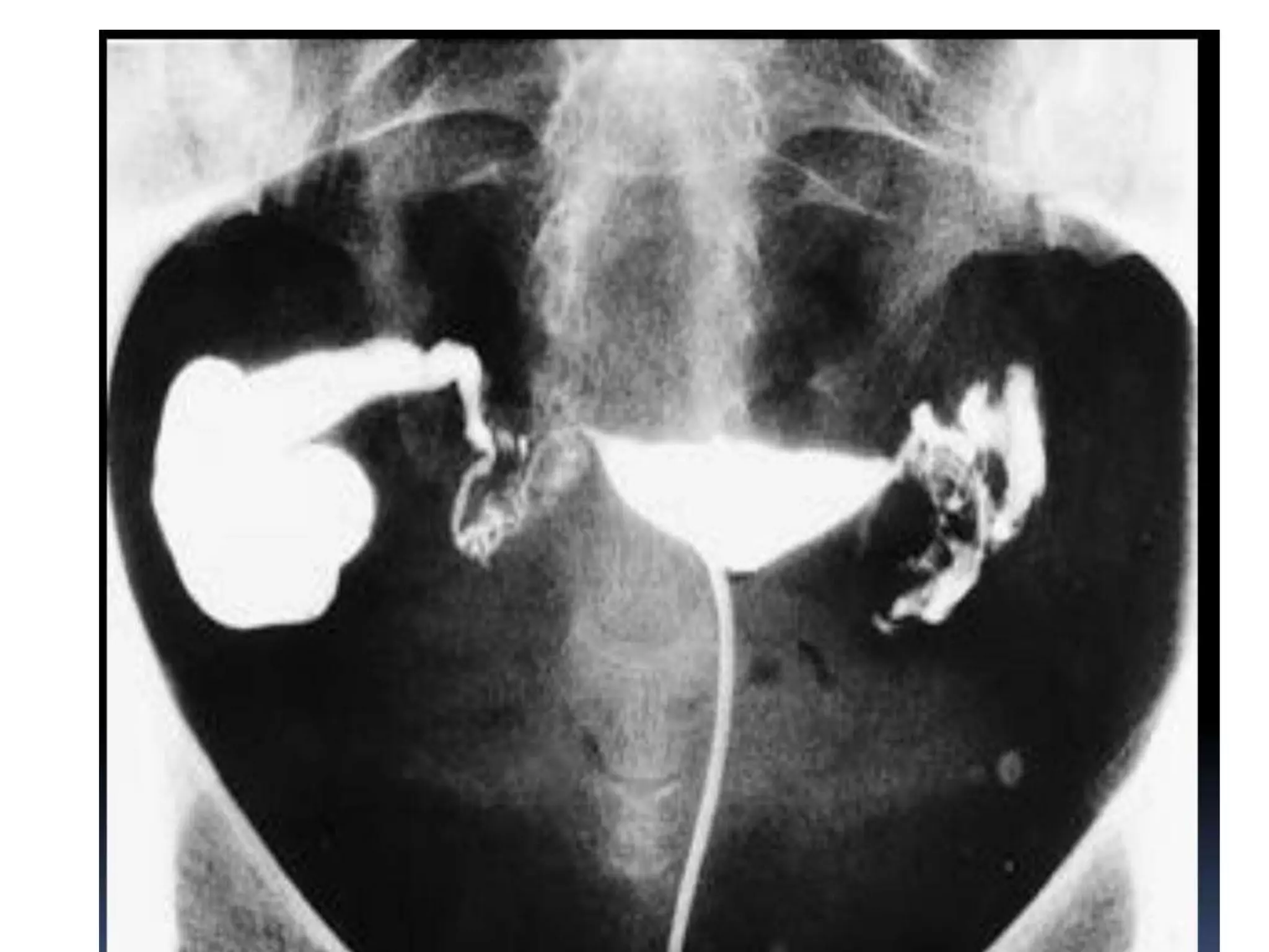 HSG AND FISTULOGRAM.pptx | Pregnancy | Reproductive Health