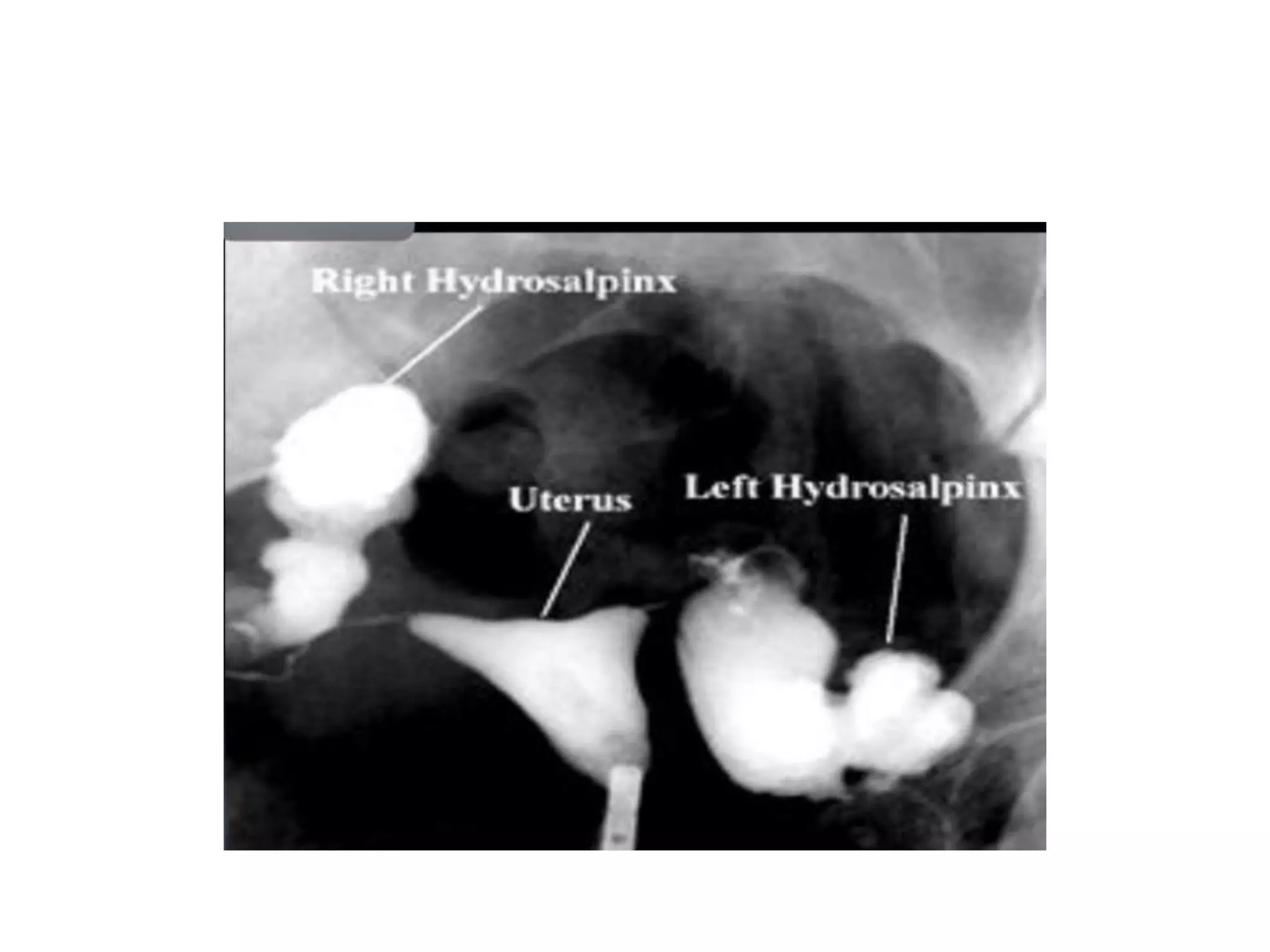 HSG AND FISTULOGRAM.pptx | Pregnancy | Reproductive Health