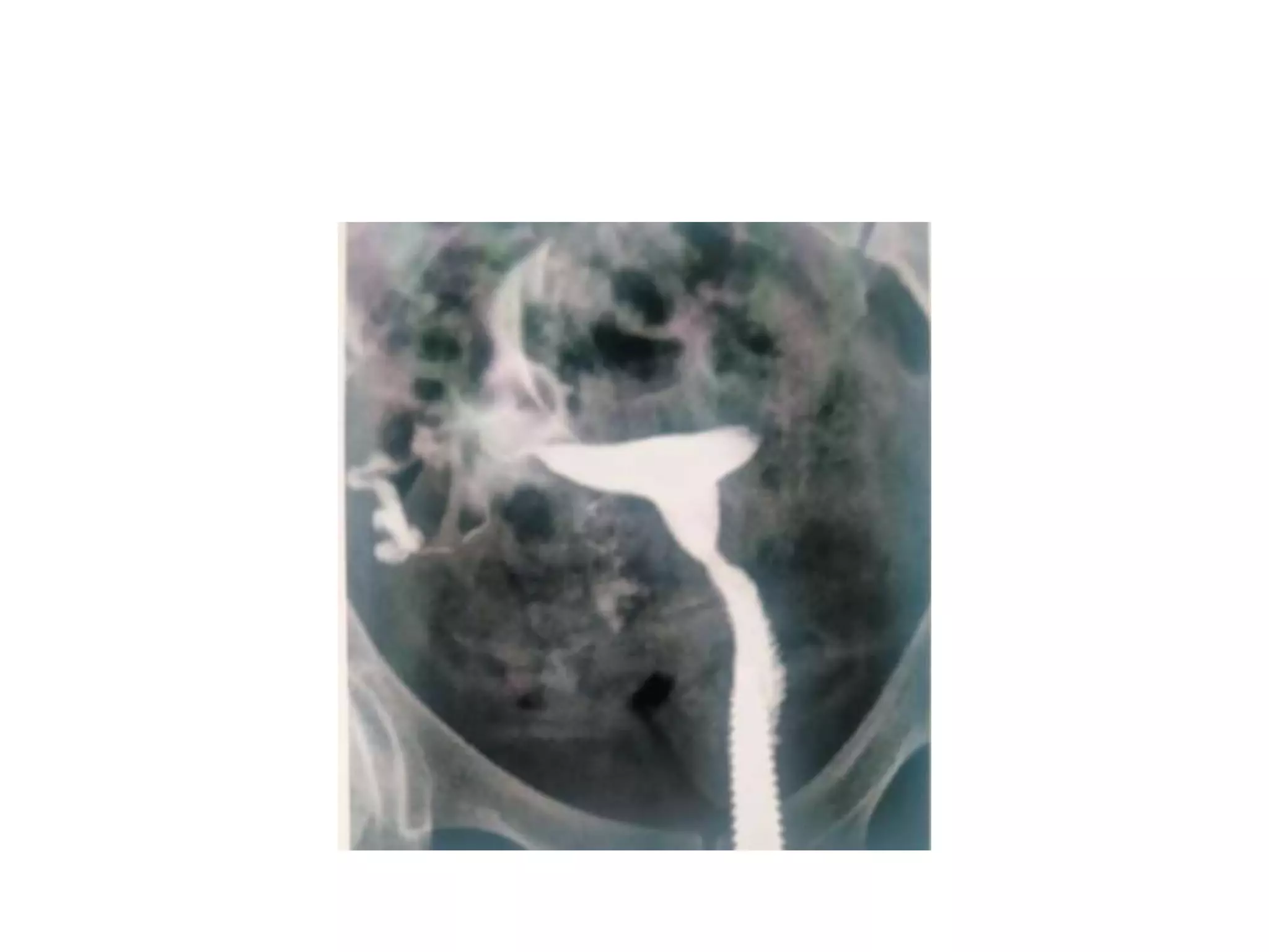 HSG AND FISTULOGRAM.pptx | Pregnancy | Reproductive Health