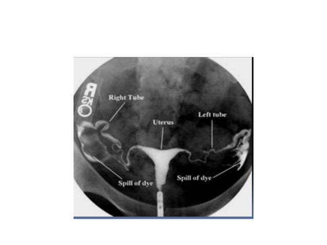HSG AND FISTULOGRAM.pptx | Pregnancy | Reproductive Health