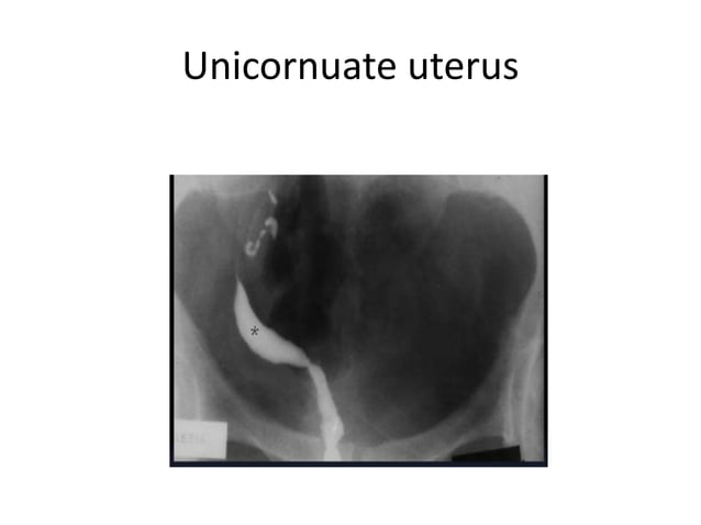 HSG AND FISTULOGRAM.pptx | Pregnancy | Reproductive Health