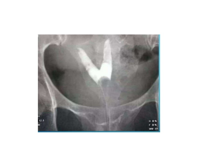 HSG AND FISTULOGRAM.pptx | Pregnancy | Reproductive Health