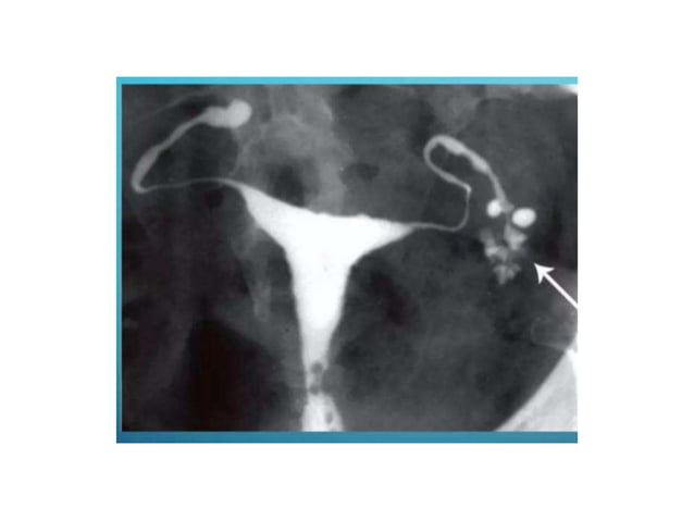 HSG AND FISTULOGRAM.pptx | Pregnancy | Reproductive Health
