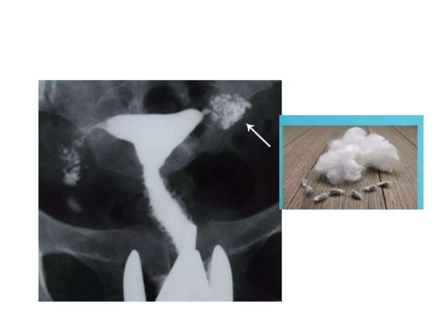 HSG AND FISTULOGRAM.pptx | Pregnancy | Reproductive Health