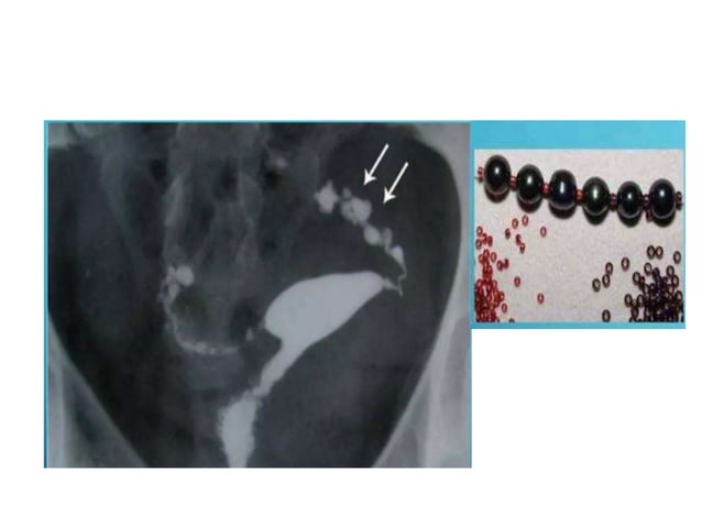 HSG AND FISTULOGRAM.pptx | Pregnancy | Reproductive Health