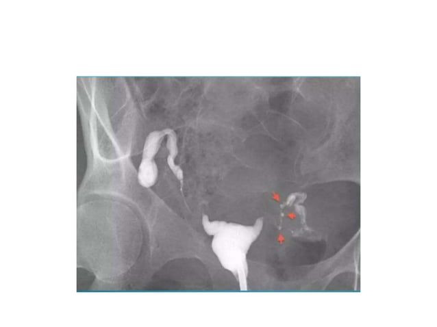 HSG AND FISTULOGRAM.pptx | Pregnancy | Reproductive Health