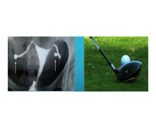 HSG AND FISTULOGRAM.pptx | Pregnancy | Reproductive Health