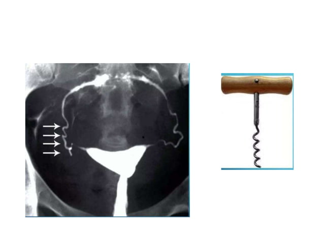 HSG AND FISTULOGRAM.pptx | Pregnancy | Reproductive Health