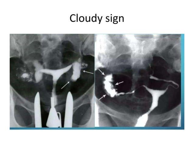 HSG AND FISTULOGRAM.pptx | Pregnancy | Reproductive Health