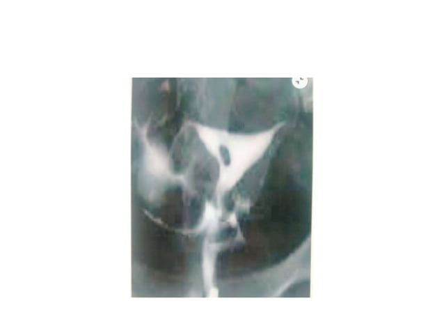 HSG AND FISTULOGRAM.pptx | Pregnancy | Reproductive Health