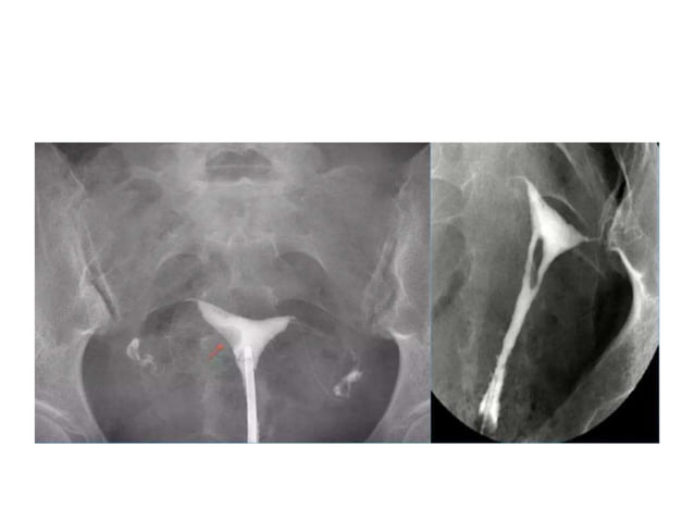 HSG AND FISTULOGRAM.pptx | Pregnancy | Reproductive Health