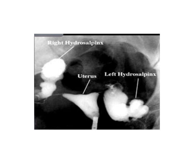 HSG AND FISTULOGRAM.pptx | Pregnancy | Reproductive Health