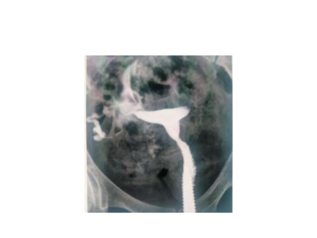 HSG AND FISTULOGRAM.pptx | Pregnancy | Reproductive Health