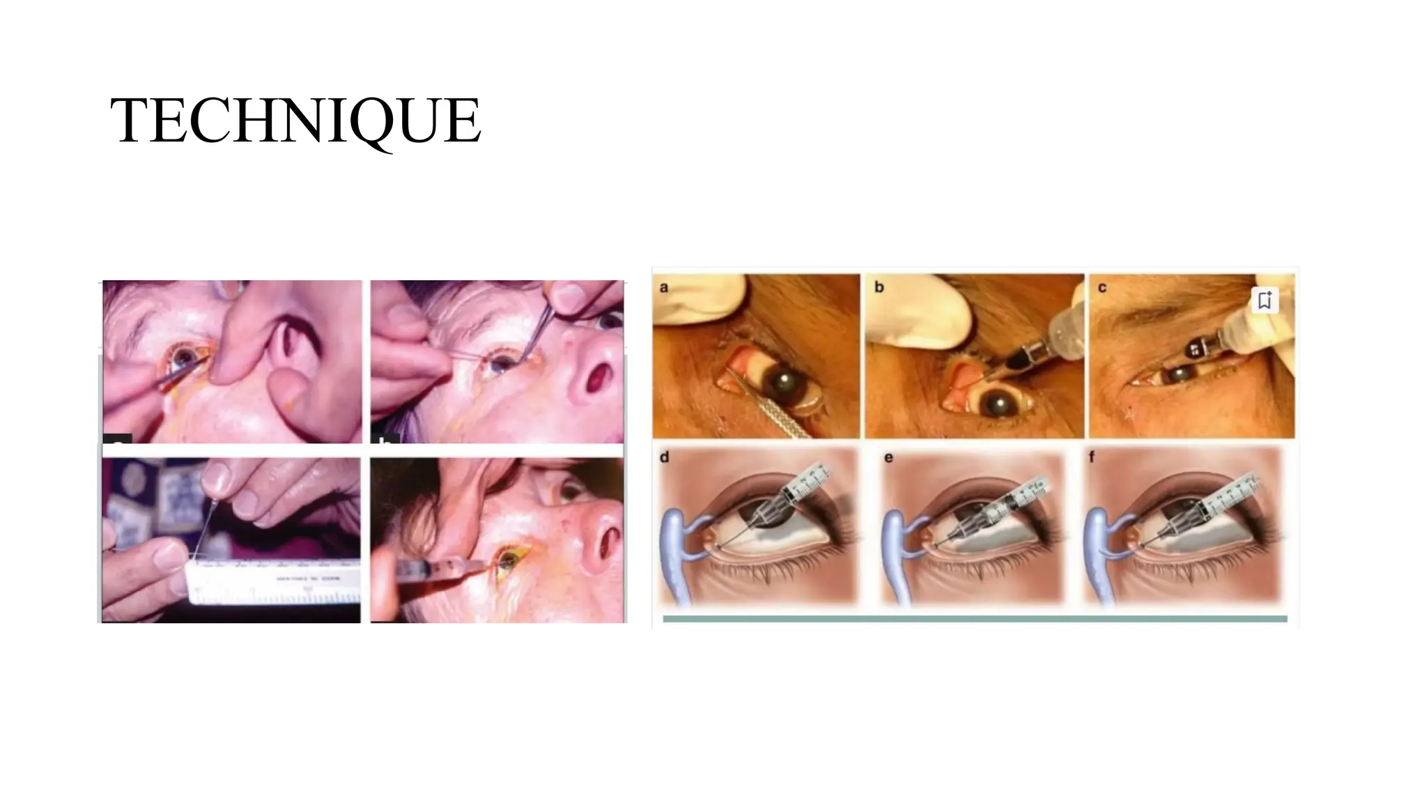 HSG, DCG & SIALOGRAPHY Special radiographic procedures | PPTX