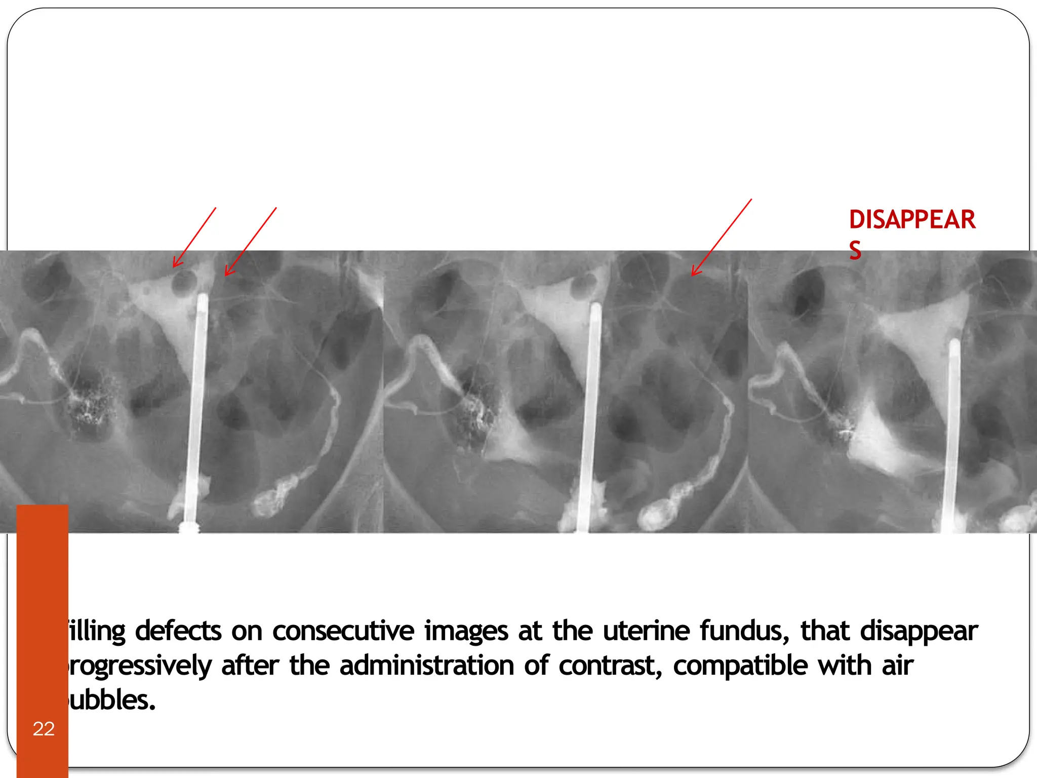 hysterosalpingography ppt for radiology.pptx