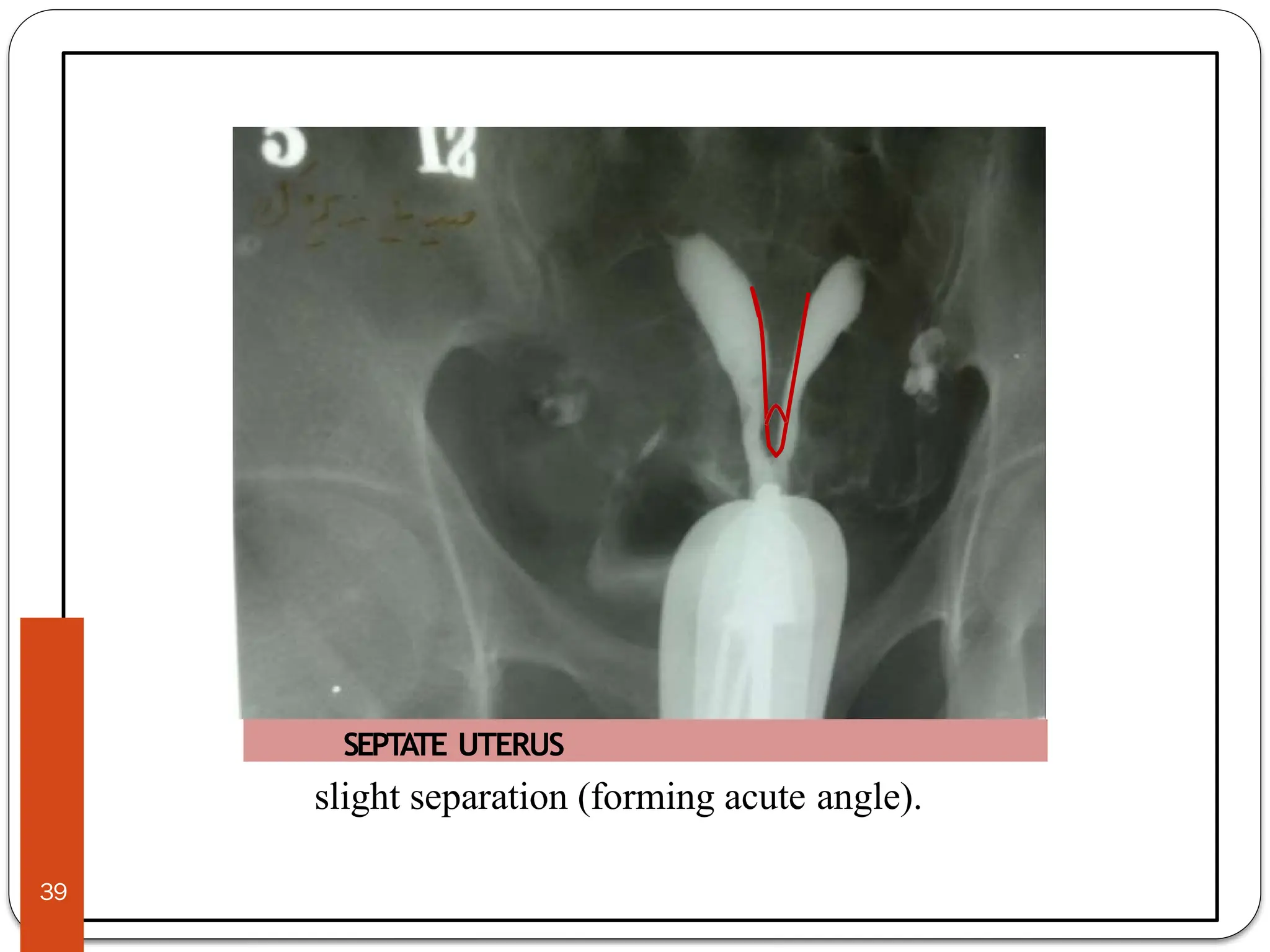 hysterosalpingography ppt for radiology.pptx