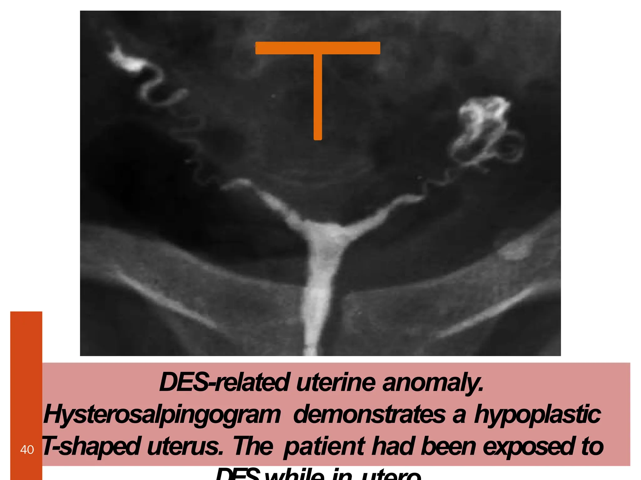 hysterosalpingography ppt for radiology.pptx | Pregnancy | Reproductive Health