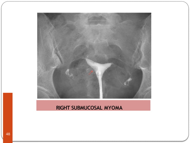 hysterosalpingography ppt for radiology.pptx | Pregnancy | Reproductive Health