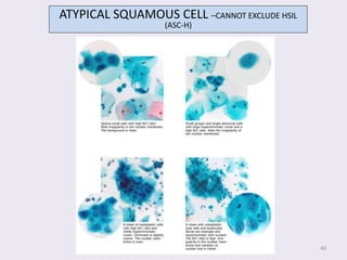 Bethesda Cervical CYtology | PPTX