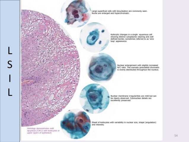 Bethesda Cervical CYtology