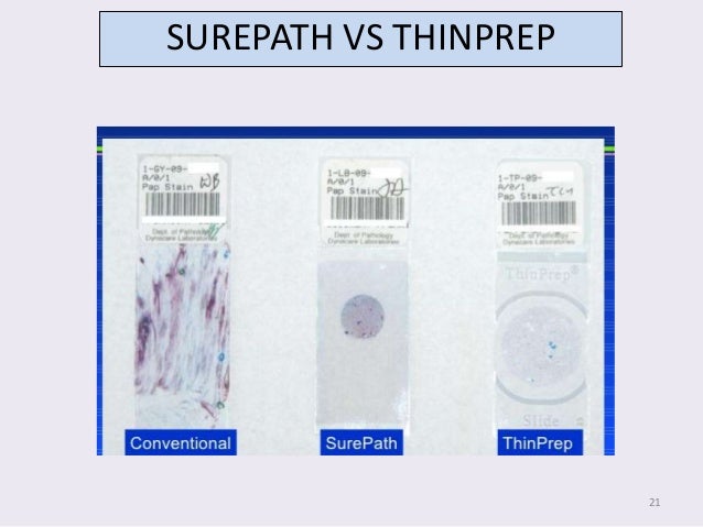 Bethesda Cervical CYtology