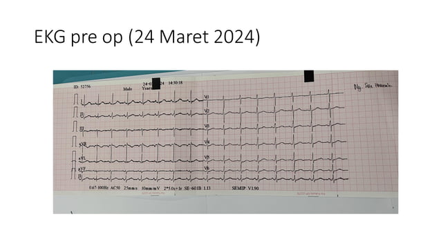H:siti hasanah:54 tahun:Diabetic foot sinistra+ DM tipe 2+ HT grade 1 ...