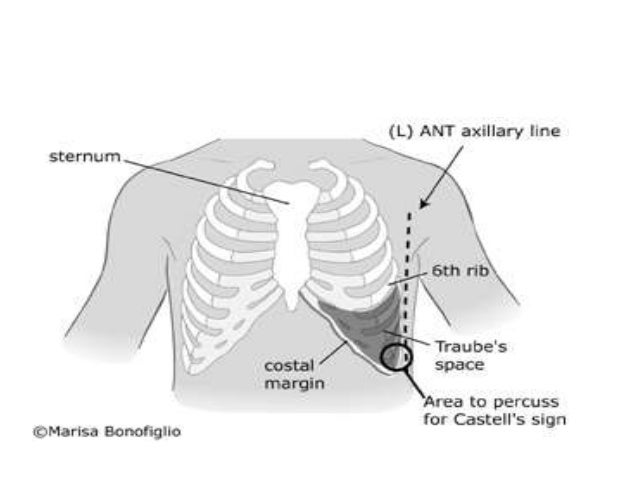 Hepato&spleenomegaly