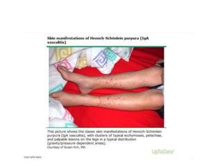 Henoch-Schönlein purpura (HSP) | PPTX
