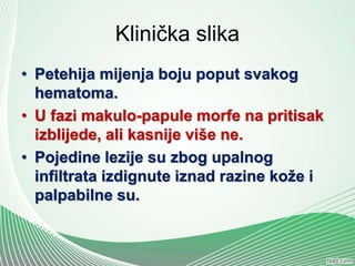 Henoch-Schoenlein purpura | PPSX