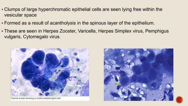 HERPES SIMPLEX VIRUS | PPTX