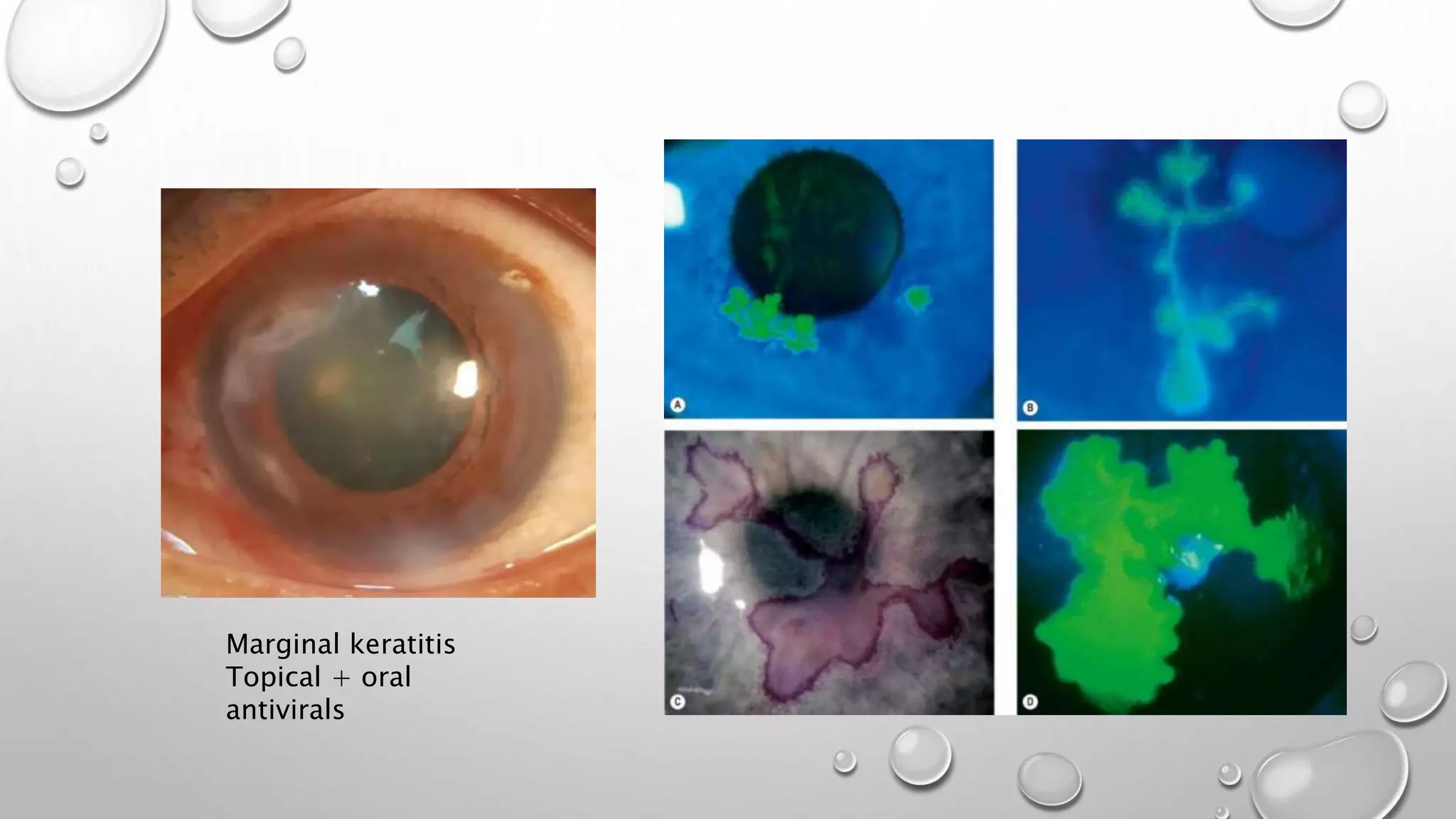 HSV keratitis | PPTX