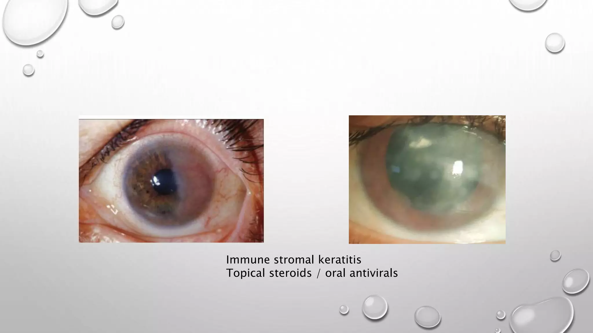 HSV keratitis | PPTX