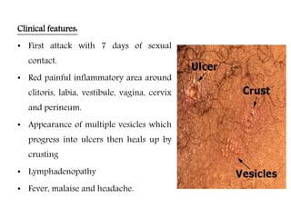 Hsv Herpes Genitalis