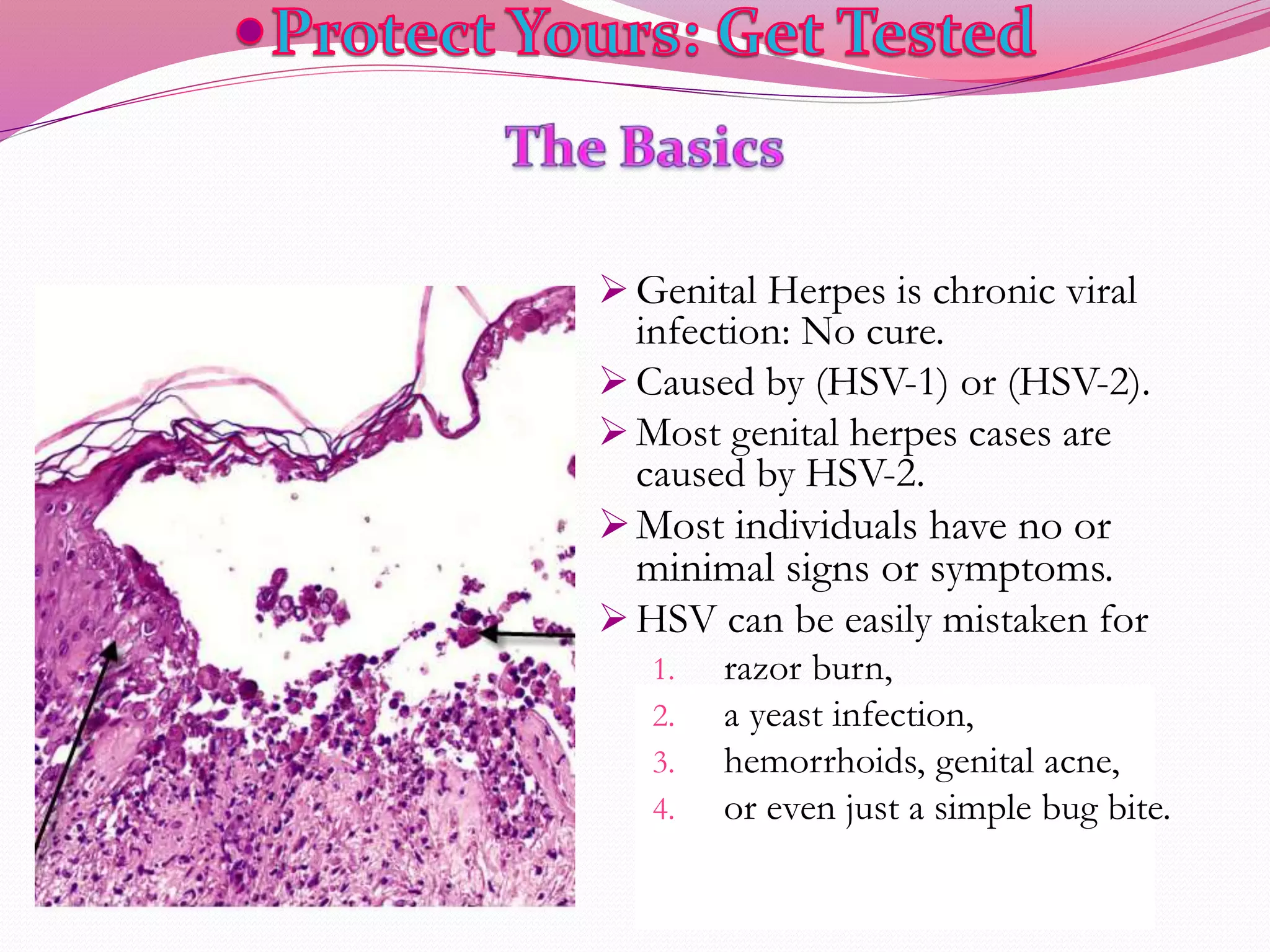 HSV1 & HSV2 Genital Herpes | PPT