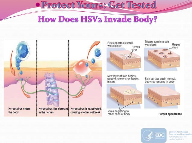 HSV1 & HSV2 Genital Herpes | PPT