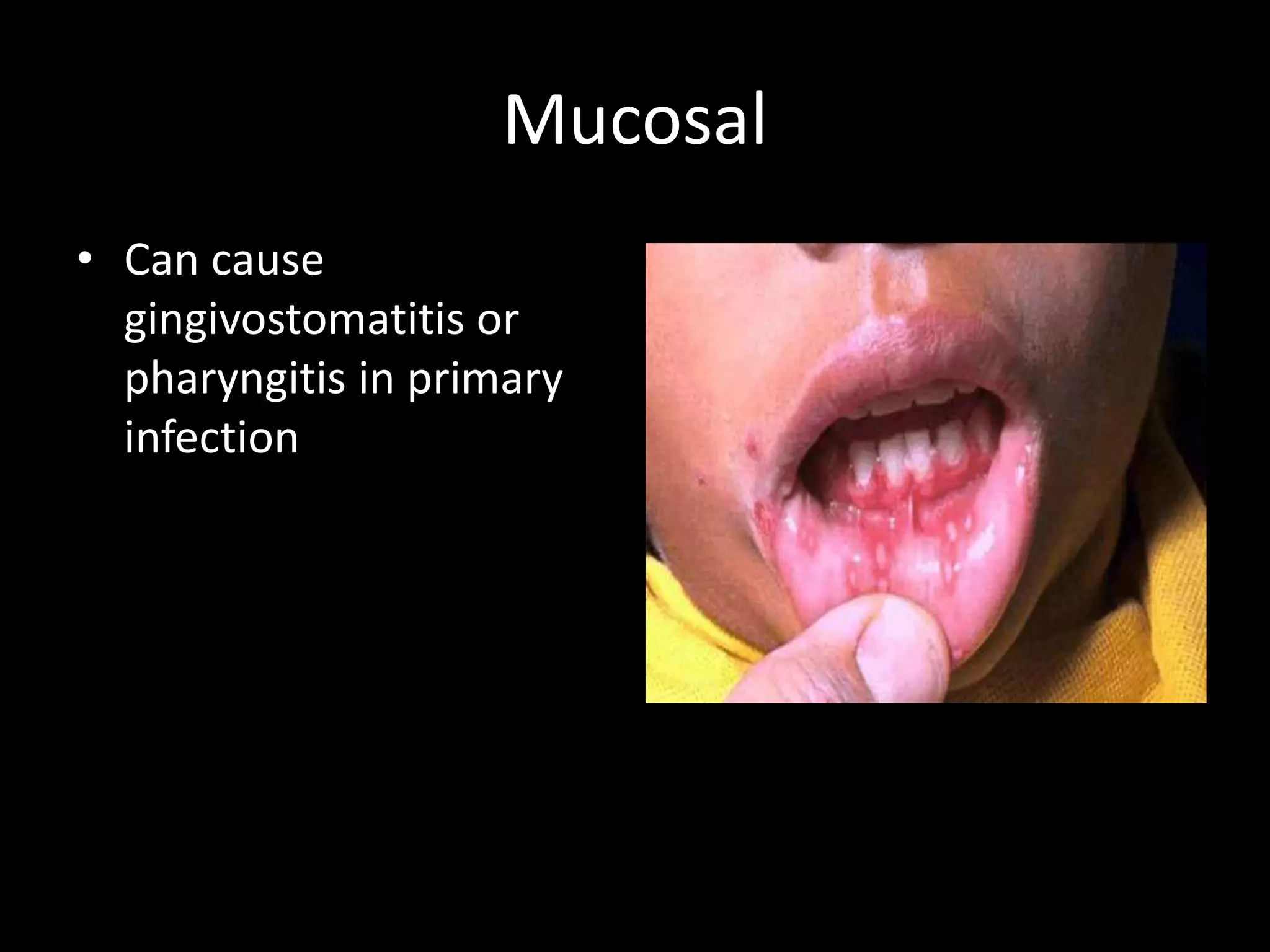 Herpes Simplex Virus (HSV) and Varicella Zoster Virus (VZV) by Dr ...