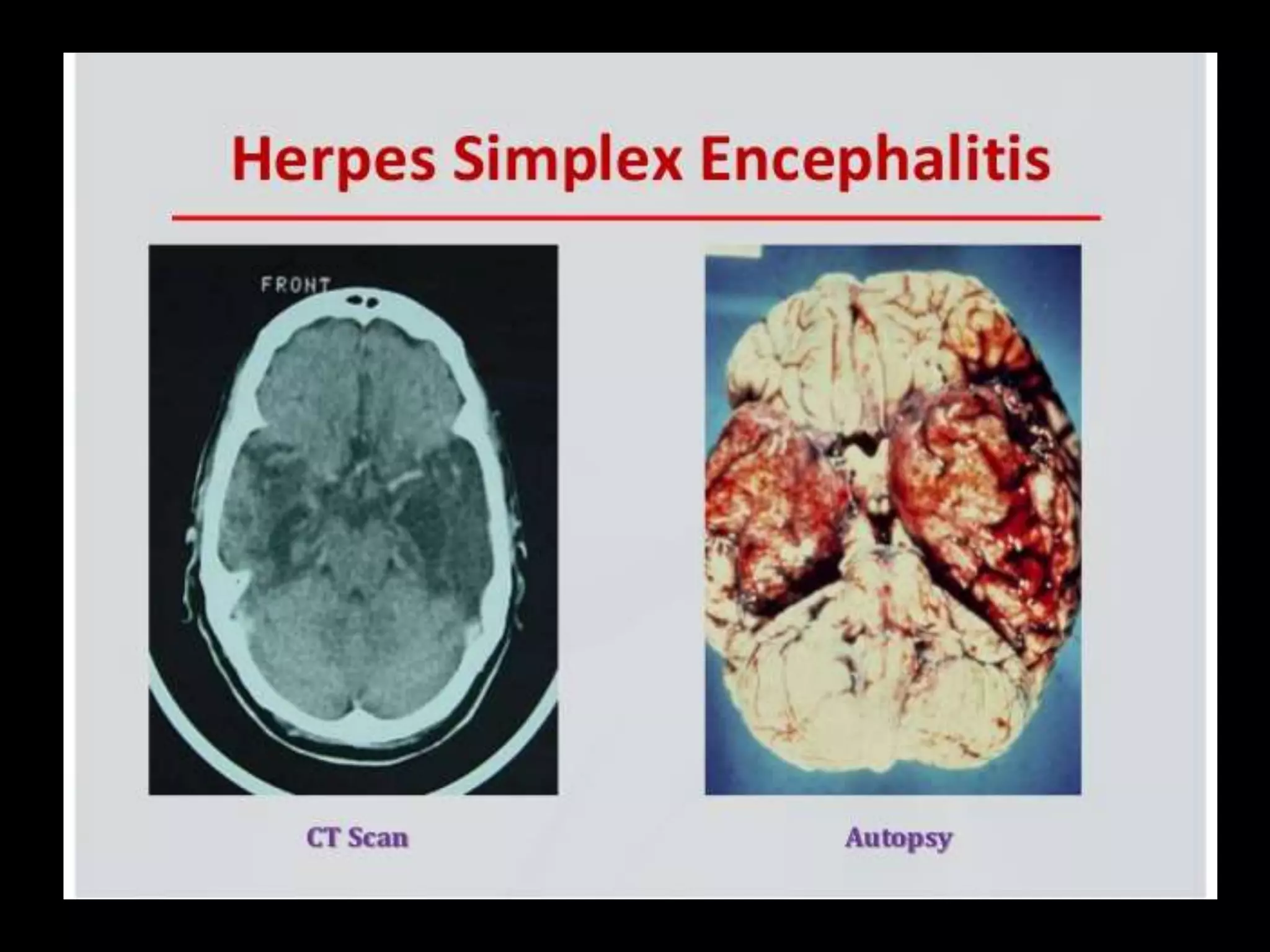Herpes Simplex Virus Hsv And Varicella Zoster Virus Vzv By Dr