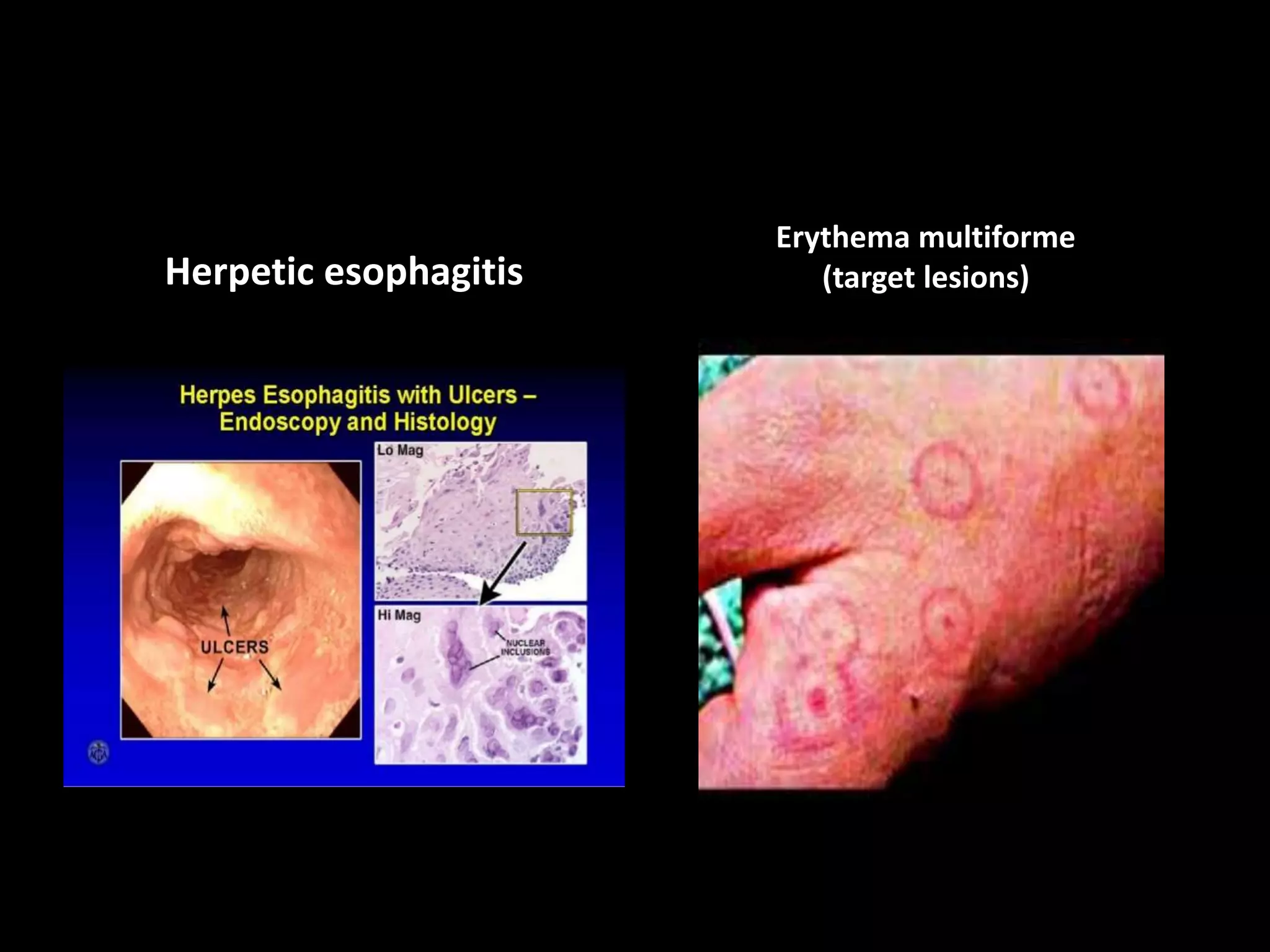 Herpes Simplex Virus (HSV) and Varicella Zoster Virus (VZV) by Dr ...