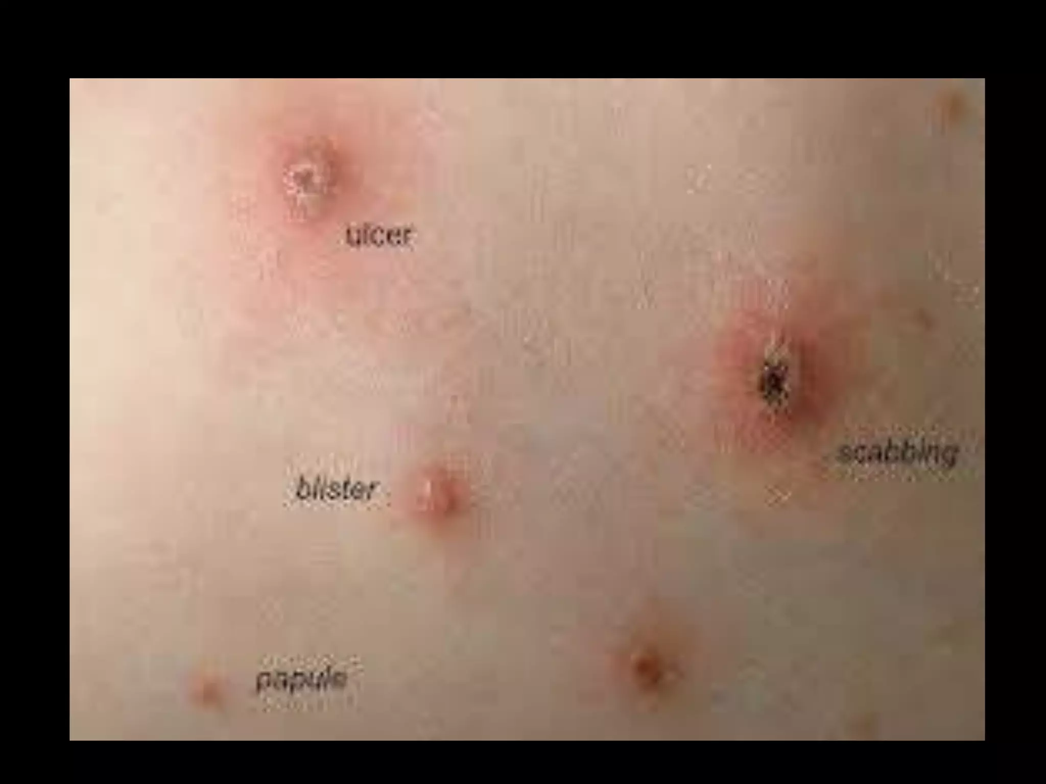 Herpes Simplex Virus (HSV) and Varicella Zoster Virus (VZV) by Dr ...