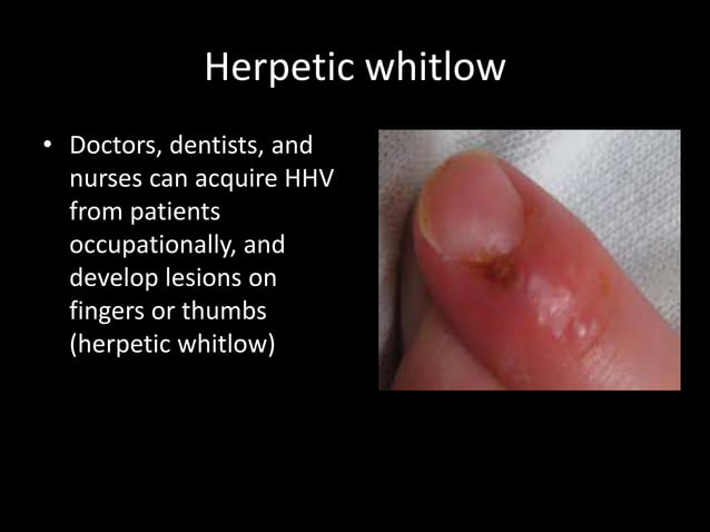 Herpes Simplex Virus (HSV) and Varicella Zoster Virus (VZV) by Dr ...