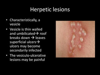 Herpes Simplex Vesicles