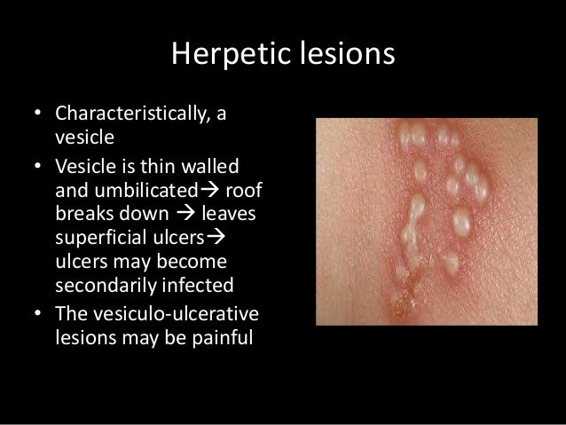 Herpes Simplex Virus (HSV) and Varicella Zoster Virus (VZV) by Dr. Hi…